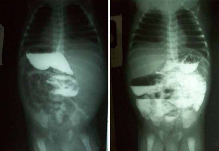 Qué es una brida intestinal y cómo es la operación que le realizaron a ...